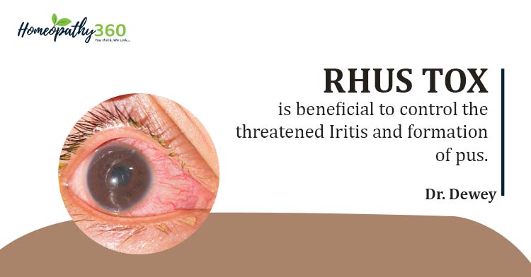 Rhus Tox Today Clinical Tips: Dr. Dewey