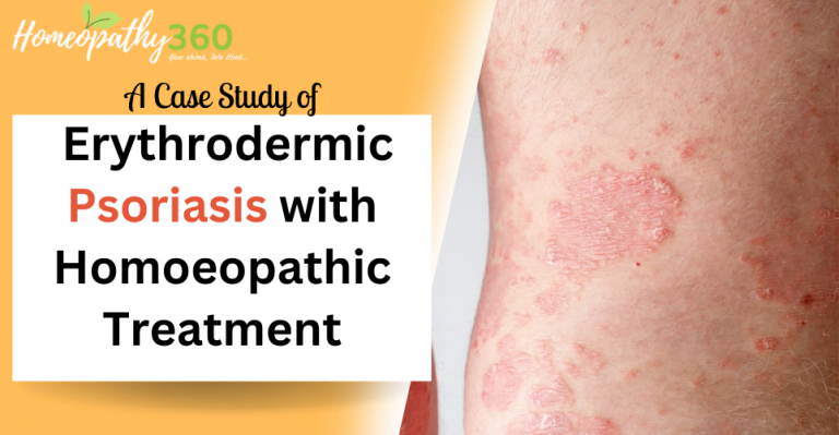 A case study of Erythrodermic Psoriasis with Homoeopathic Treatment ...