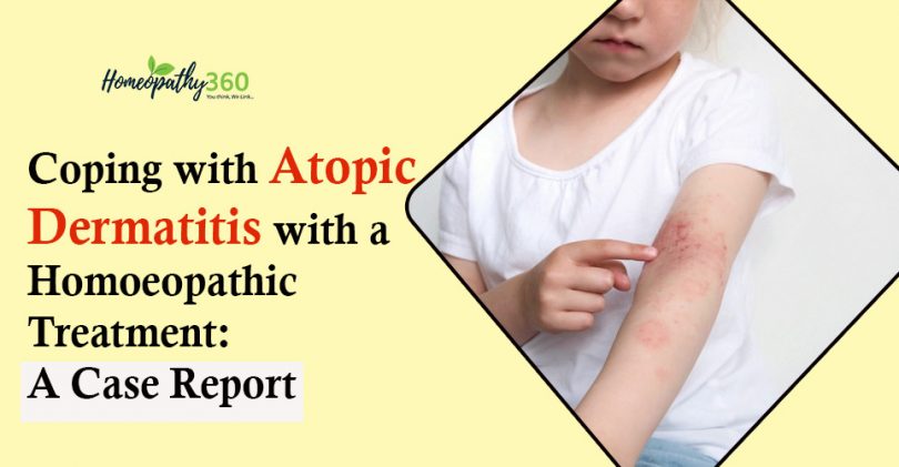 Coping with Atopic Dermatitis with a Homoeopathic Treatment: A Case Report