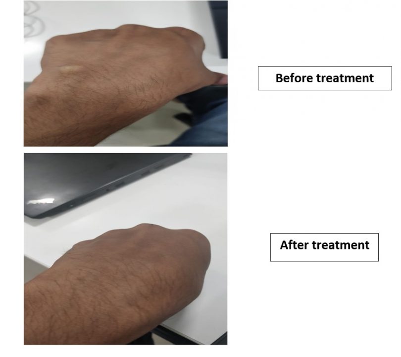 A Case Report of Ganglion Cyst Treated With Homoeopathic Individualised ...