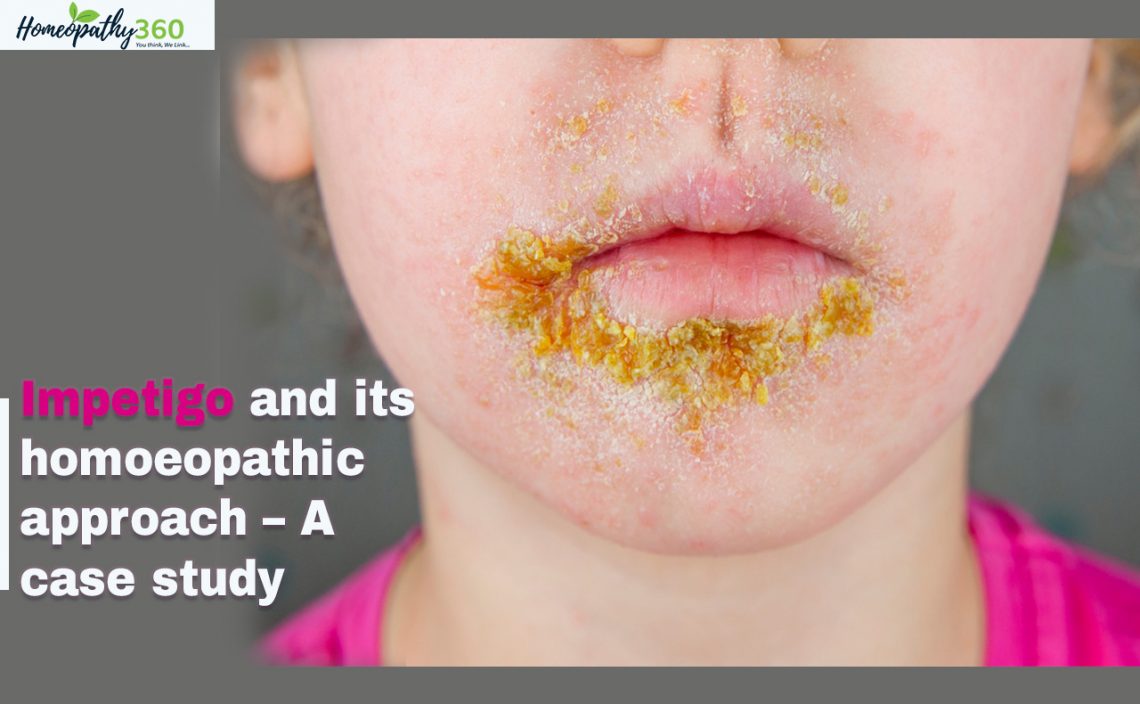 Impetigo and its homoeopathic approach – A case study