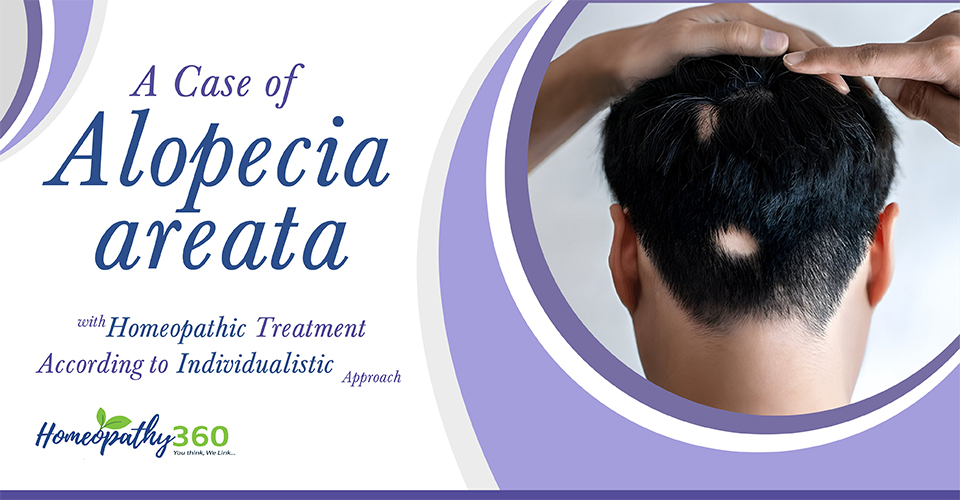 A Case Study of Alopecia Areata with Homoeopathic Treatment according ...