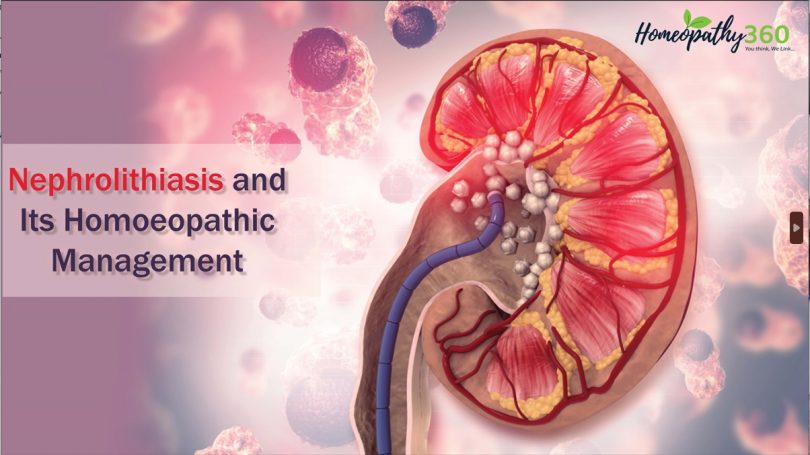 Nephrolithiasis and Its Homoeopathic Management