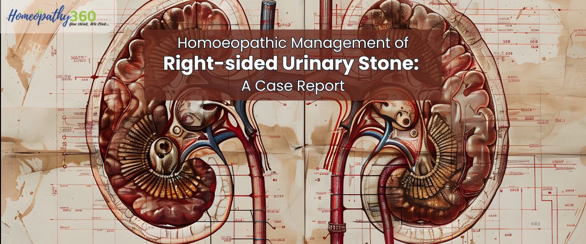 Homoeopathic Management of Right-sided Urinary Stone: A Case Report