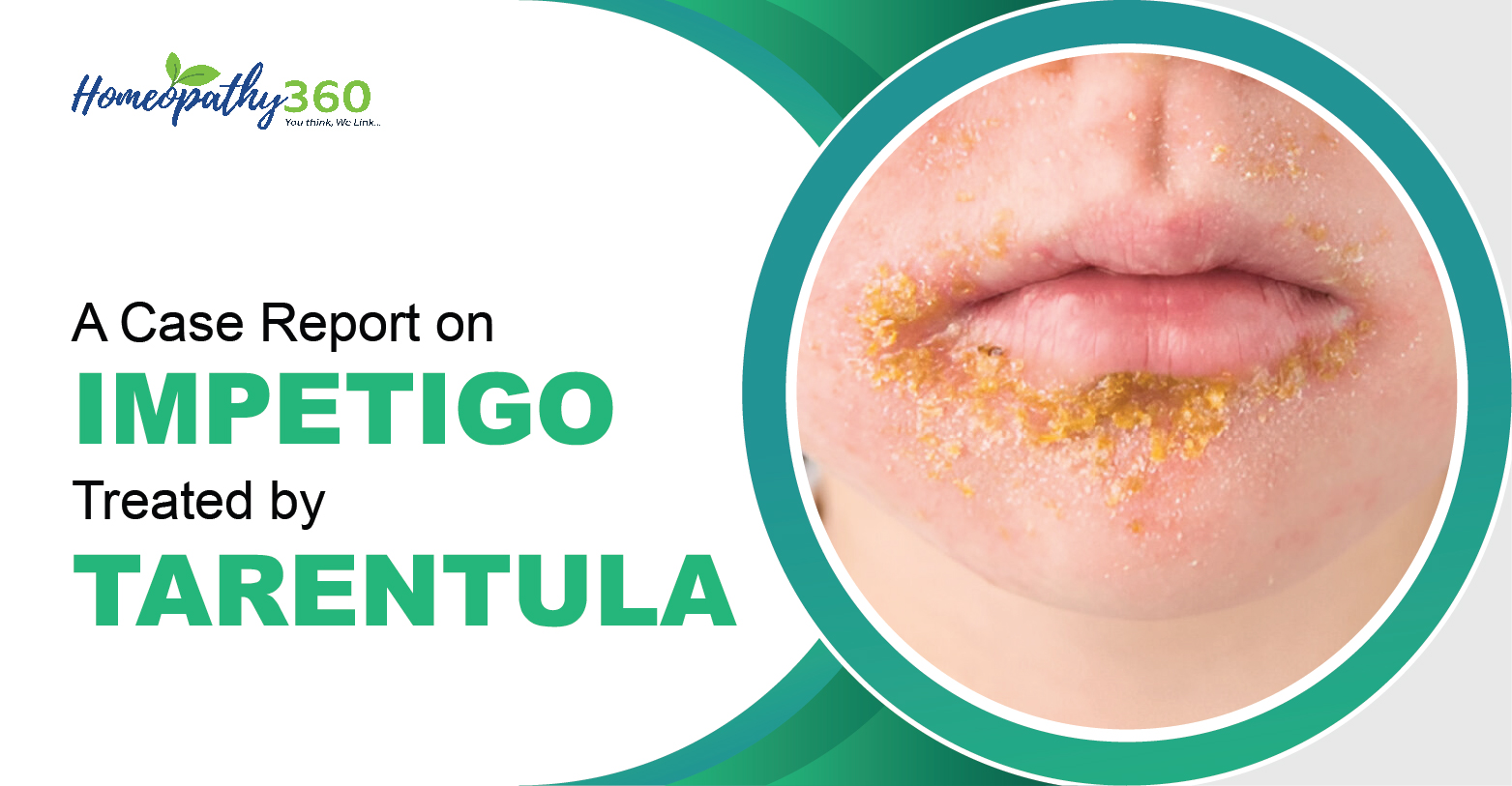 A Case Report on Impetigo Treated by Tarentula