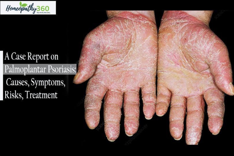 A Case Report on Palmoplantar Psoriasis: Causes, Symptoms, Risks, Treatment