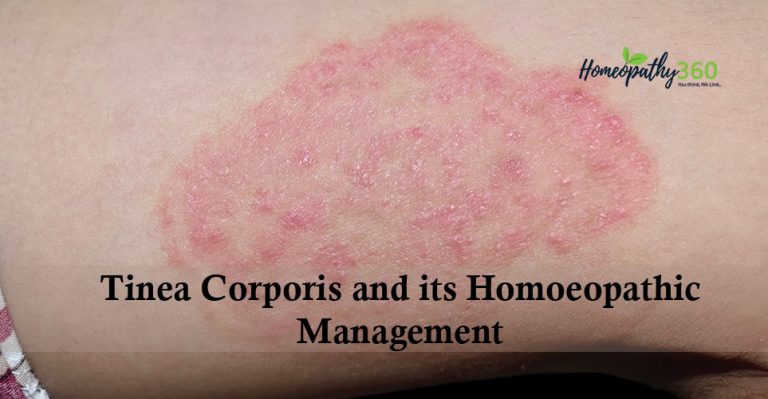 Tinea Corporis and its Homoeopathic Management