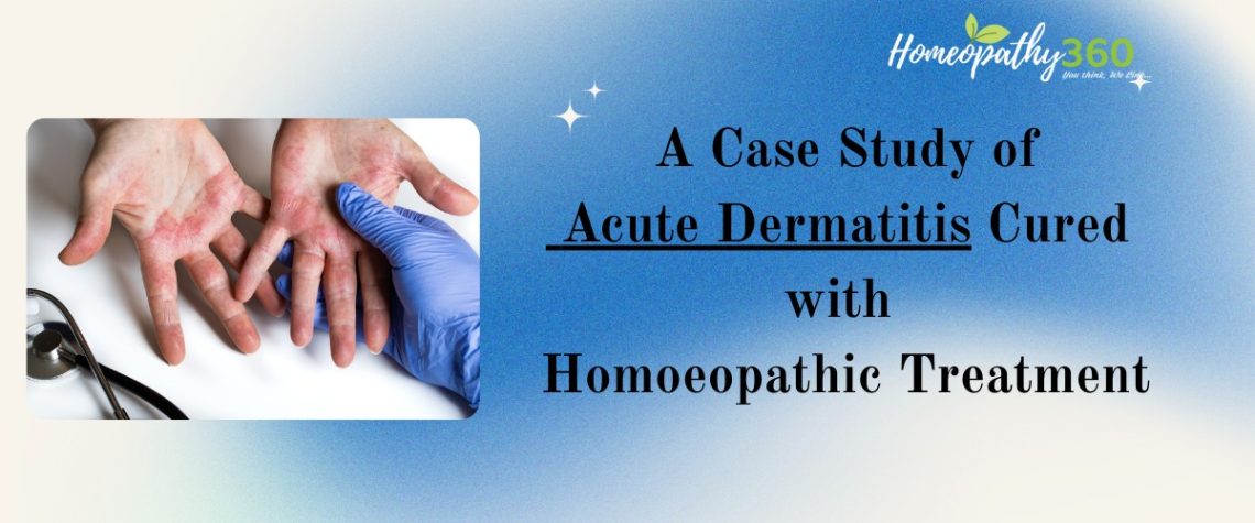 A CASE STUDY OF ACUTE DERMATITIS CURED WITH HOMOEOPATHIC TREATMENT ...
