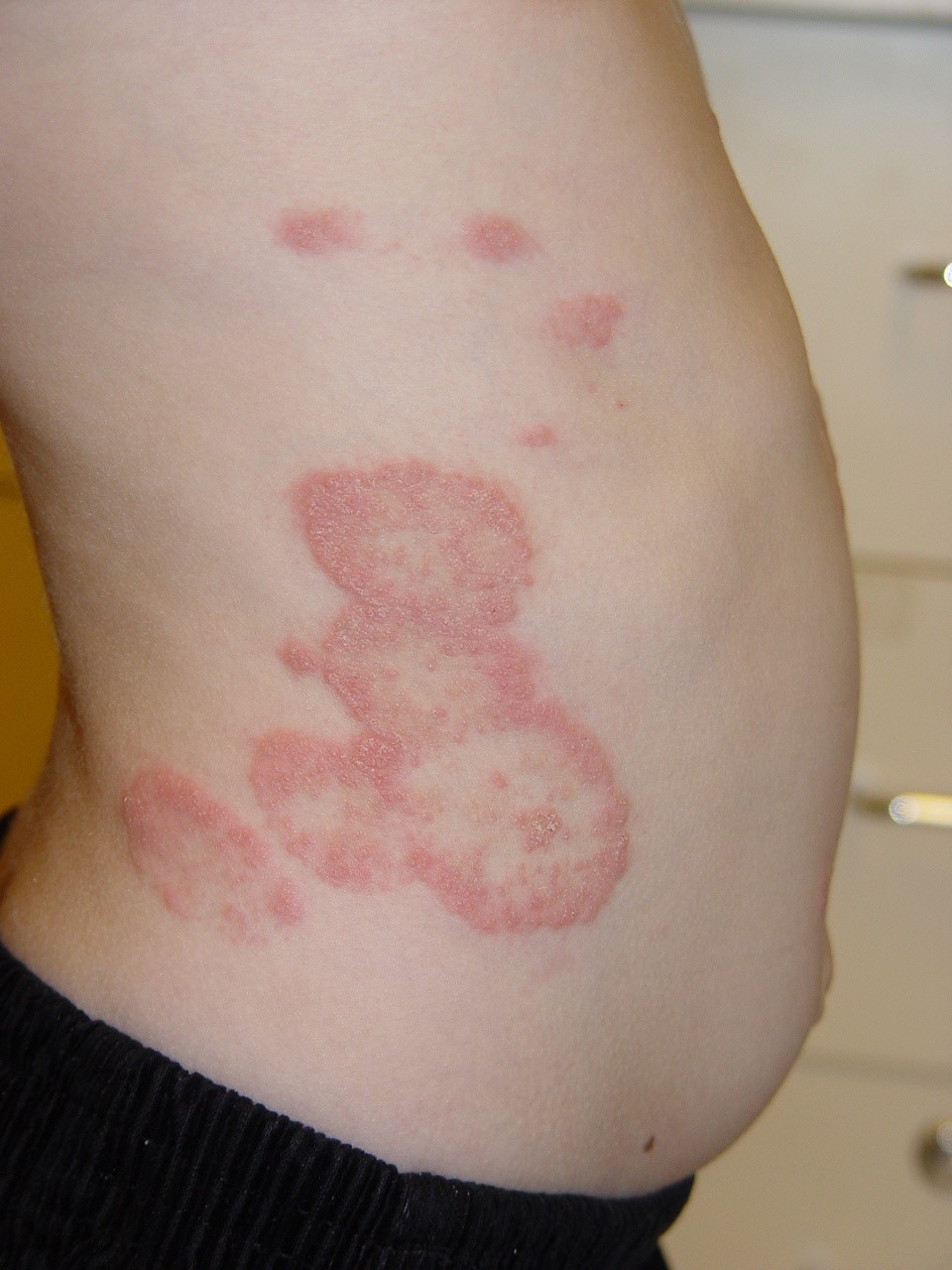tinea cruris, tinea infection treatment, types of tinea