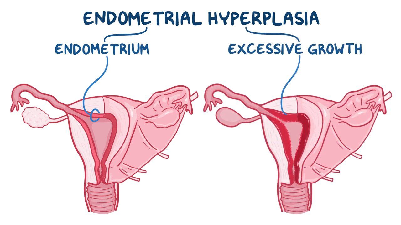 Bulky Mildly Retroverted Uterus With Anterior Corpal Subserous Myoma 