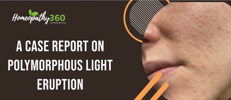 A case report on polymorphous light eruption - homeopathy360