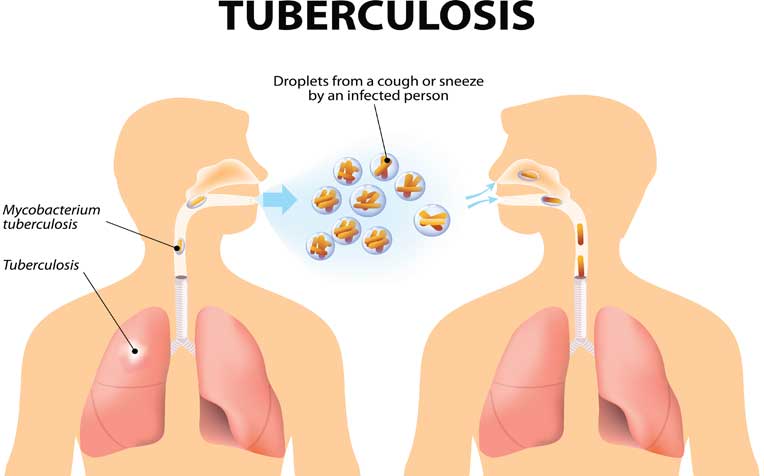 Tubercular State and Tuberculosis by Dr Goutam Das - homeopathy360